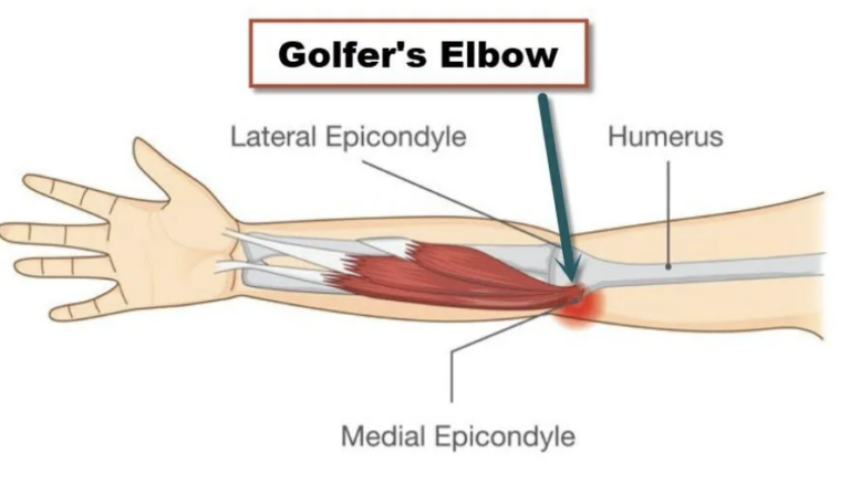 "Putting" Up With Pain: Treating The 5 Most Common Golf Injuries - West ...